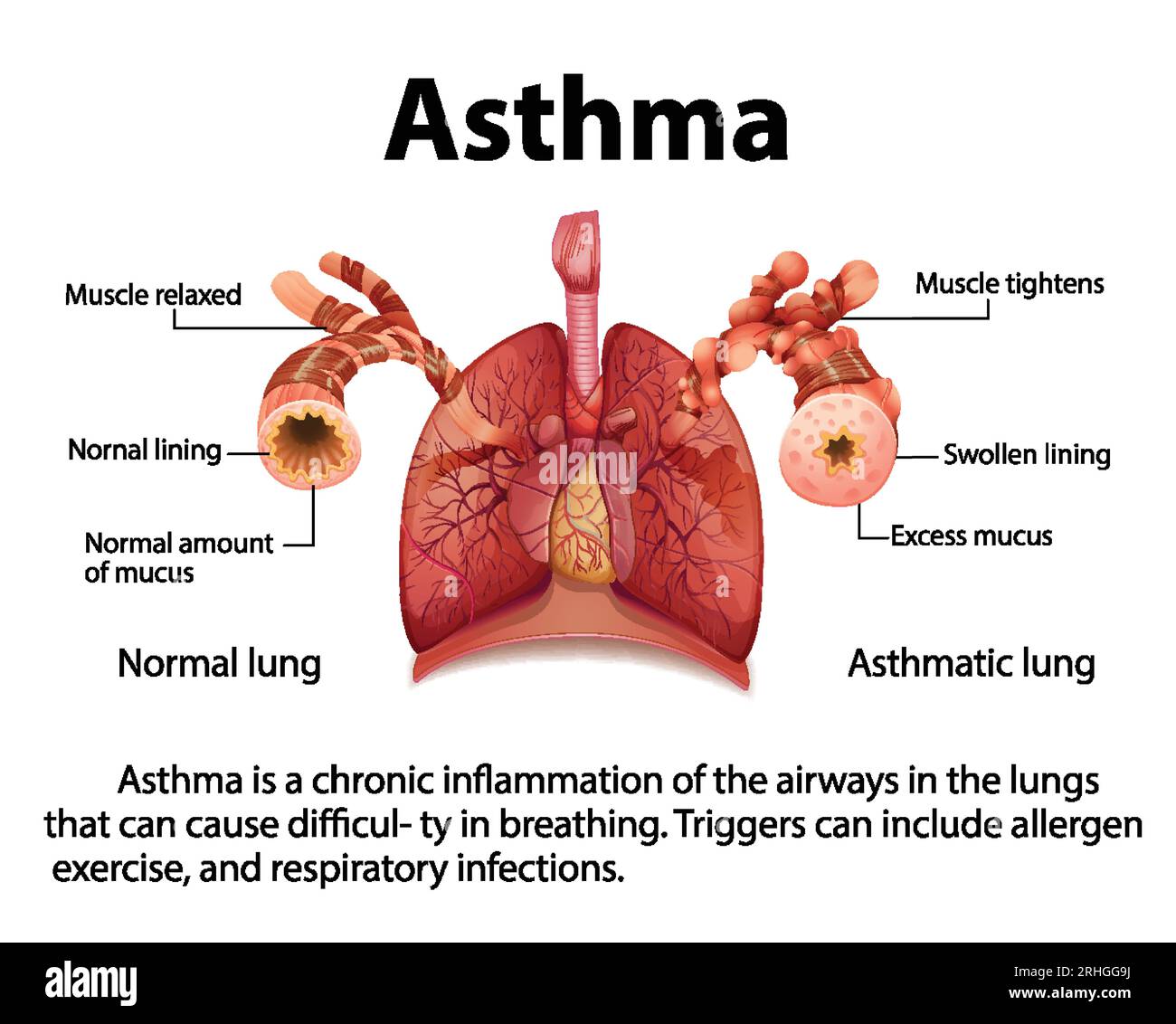 Illustrated Infographic Comparing Human Anatomy Of Normal And Asthma Lungs Stock Vector Image