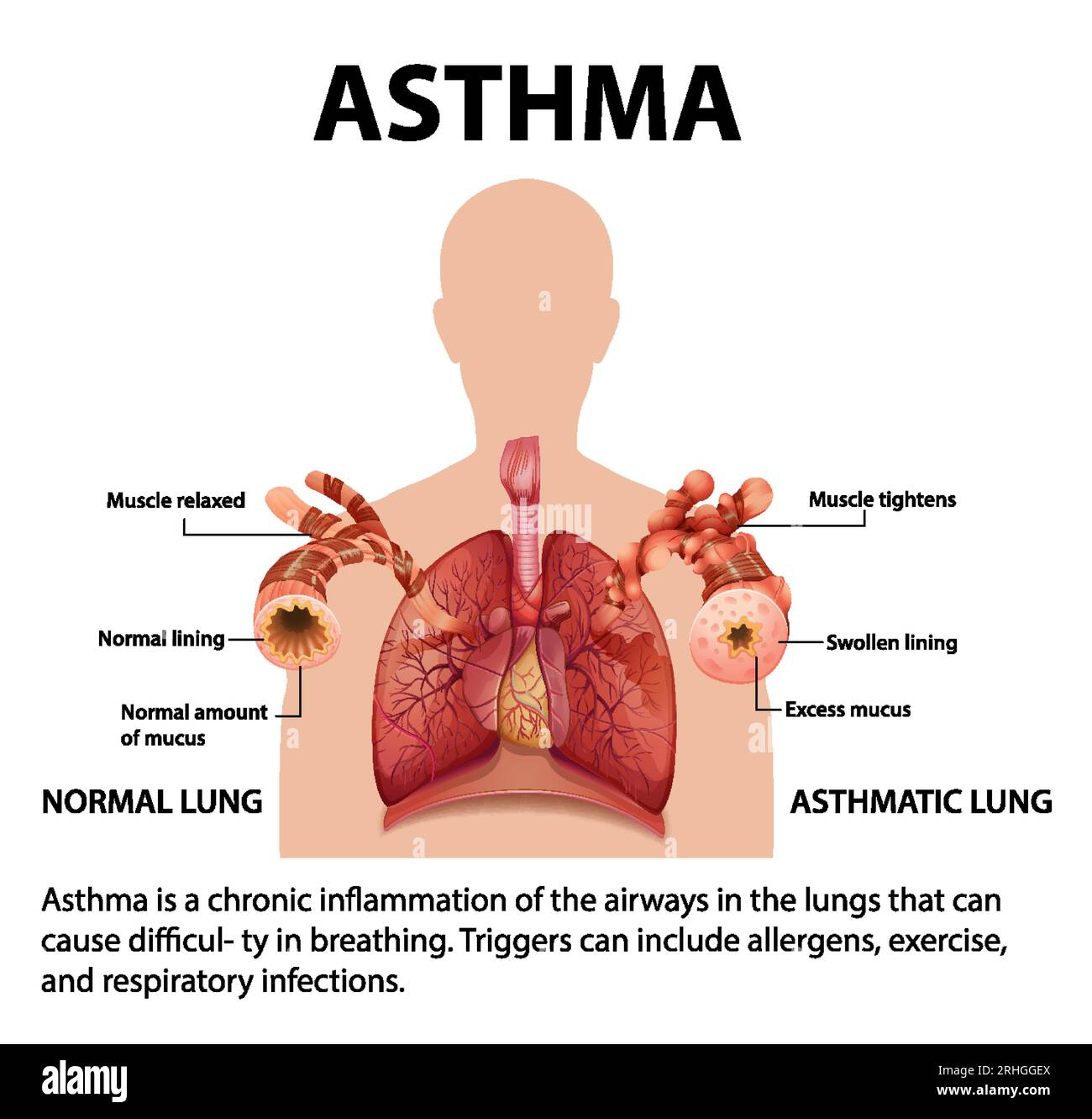 Medical illustration comparing normal hi-res stock photography and ...