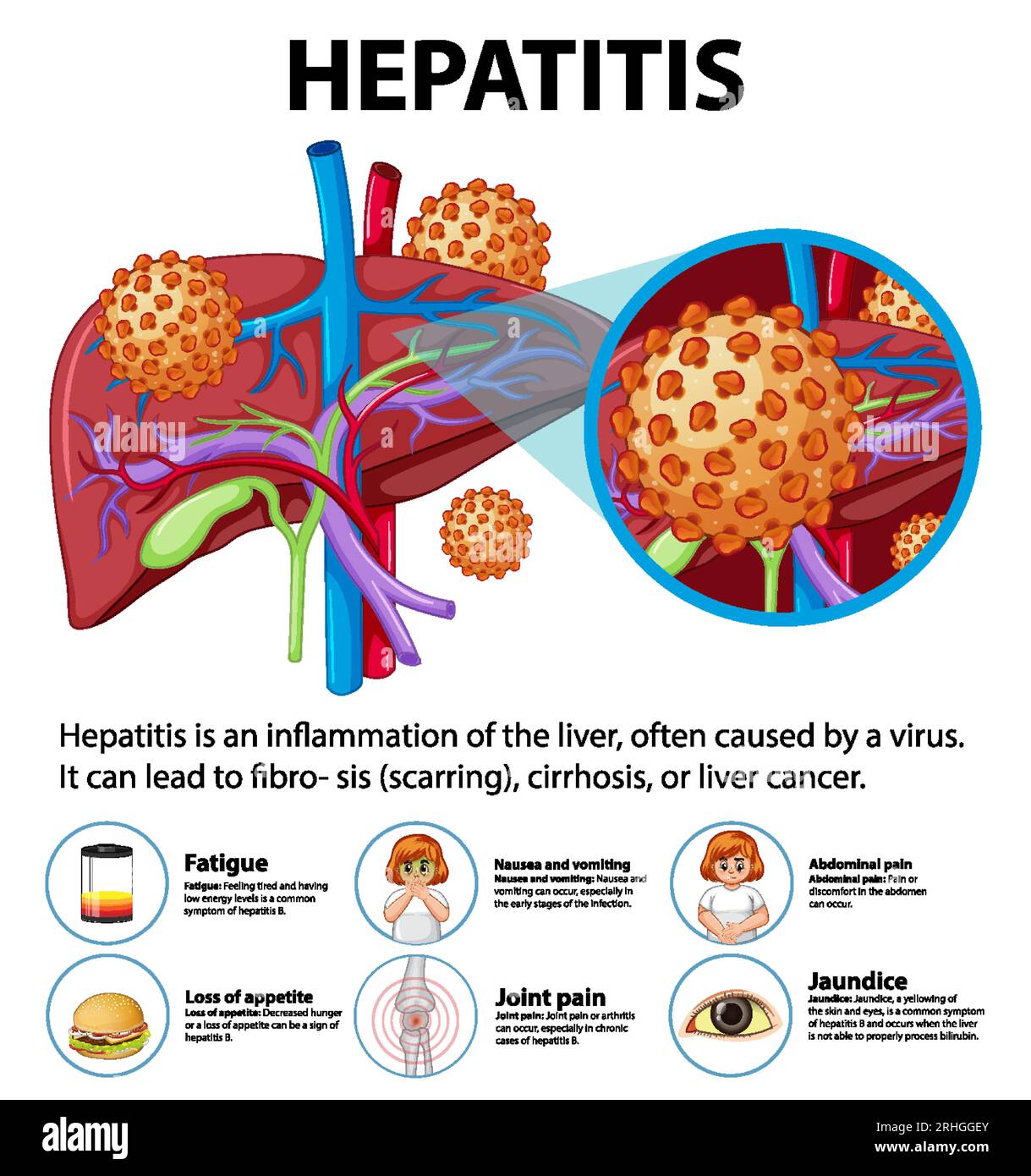 Illustration Of Liver With Hepatitis And Its Effects On The Body Stock Vector Image And Art Alamy