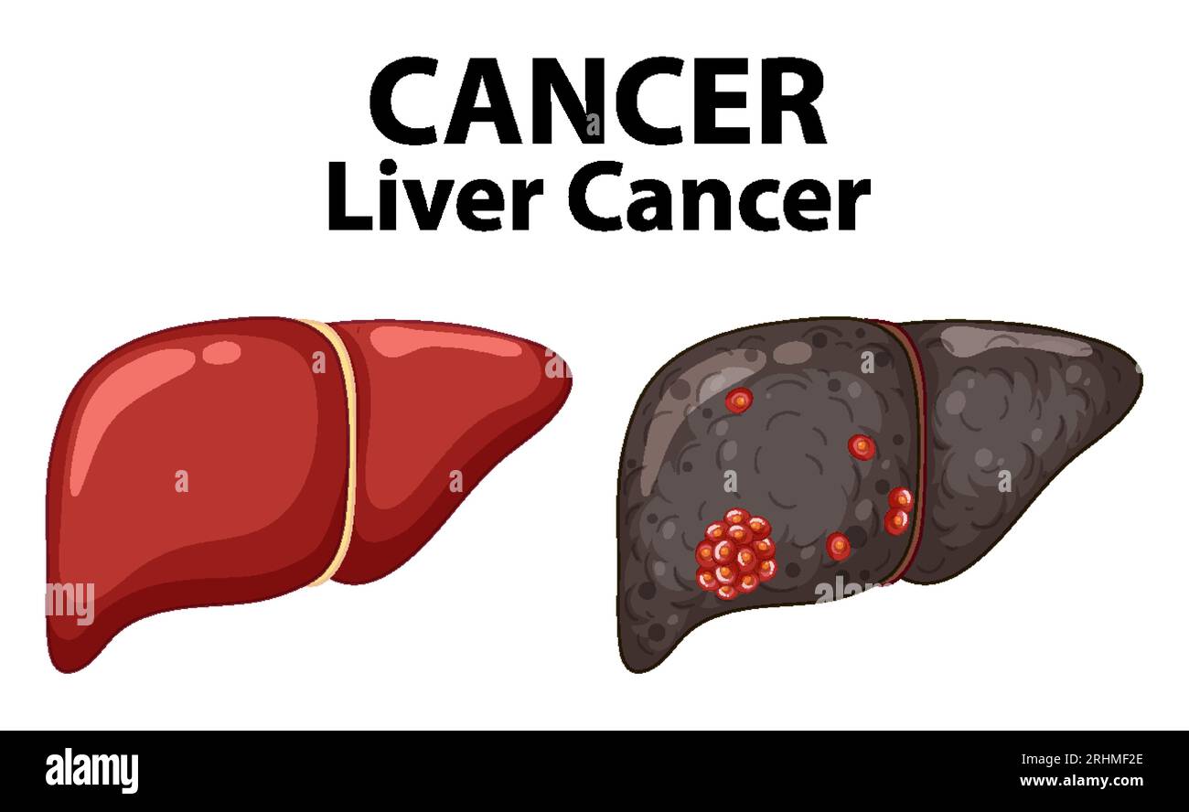 Infographic Illustrating The Anatomy Of Liver Cancer Cells Stock Vector Image And Art Alamy