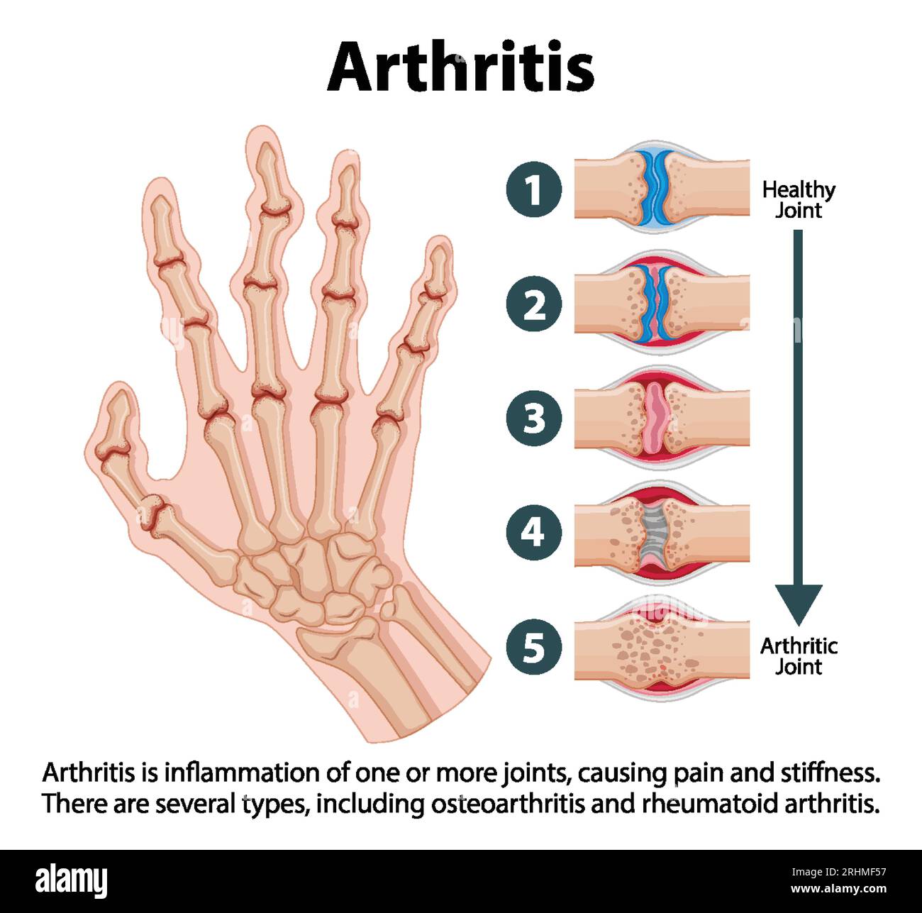 Illustrated infographic depicting stages of arthritis in human hand ...