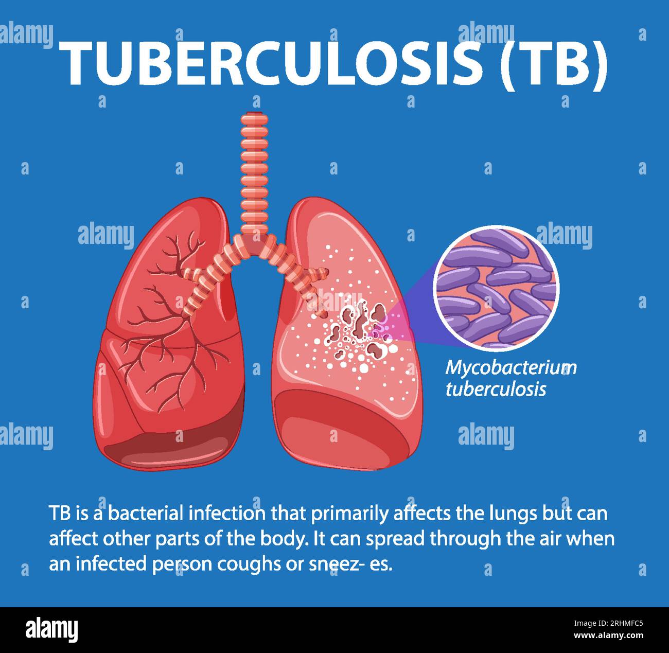 Illustrated infographic depicting the medical education of human lung ... Illustrated infographic depicting the medical education of human lung ...