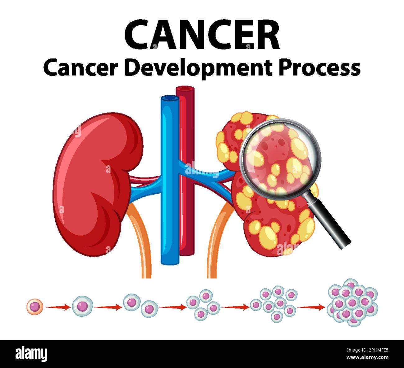 Illustrated infographic depicting the process of cancer development on ...