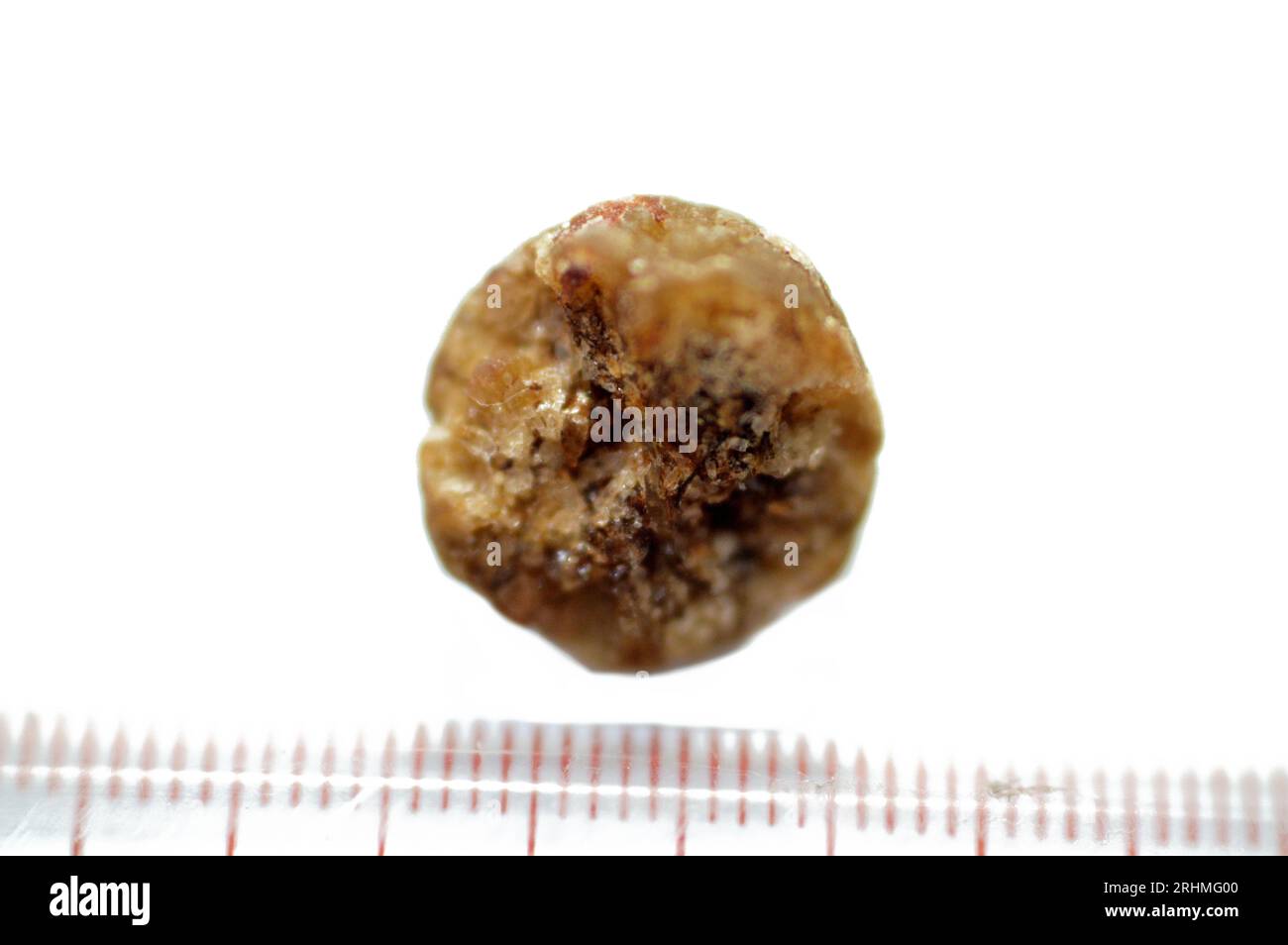 Large gallstone removed surgically after laparoscopic cholecystectomy ...