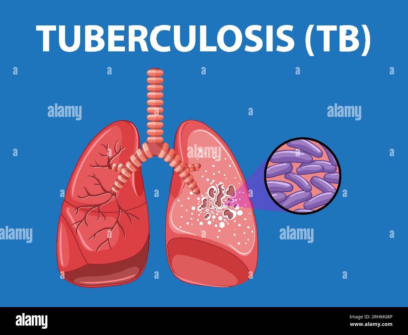 Illustration of human lung anatomy showcasing tuberculosis infection ...
