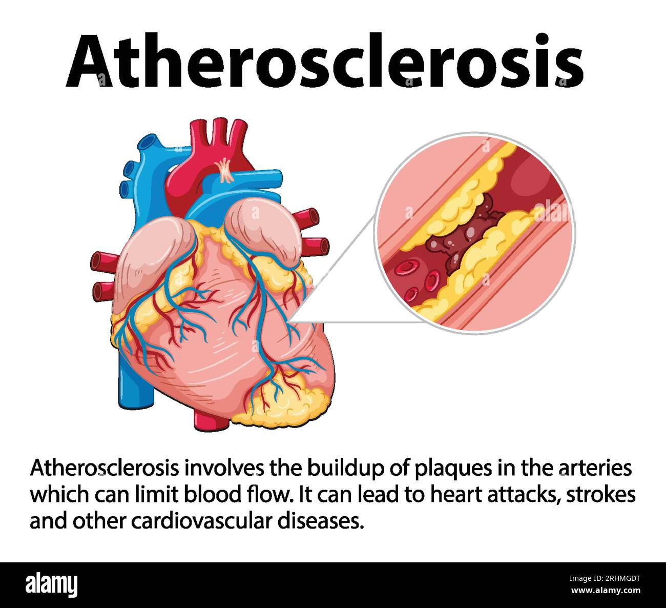Learn about heart health and disease through a visual infographic Stock ...