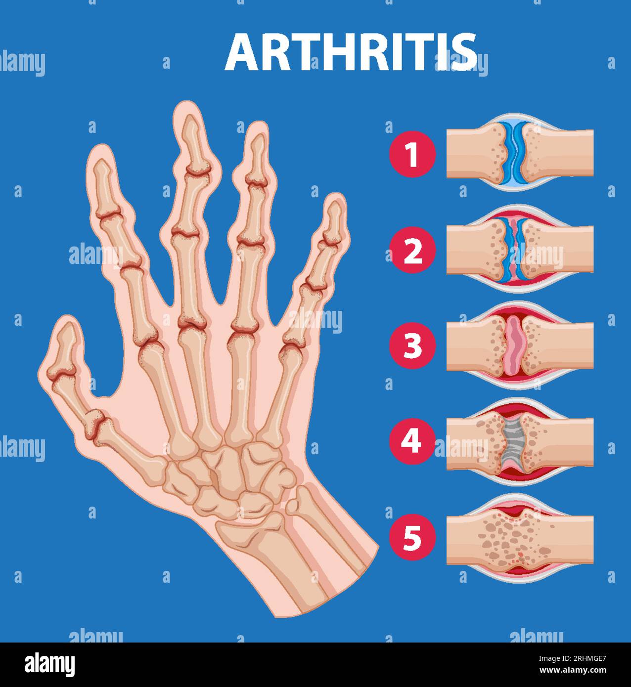 Illustrated stages of arthritis in a human hand Stock Vector Image ...