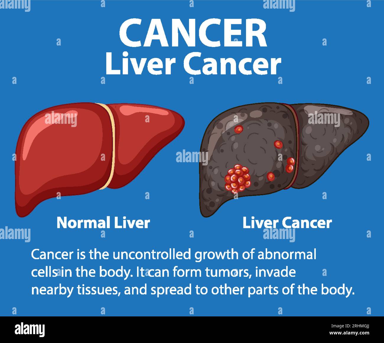 Infographic illustrating the differences between healthy and abnormal ...