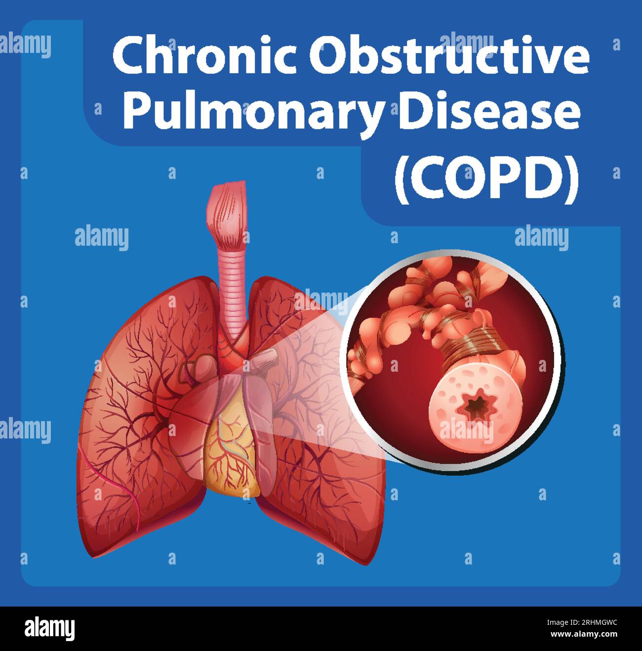 Illustrated infographic explaining chronic obstructive pulmonary ...