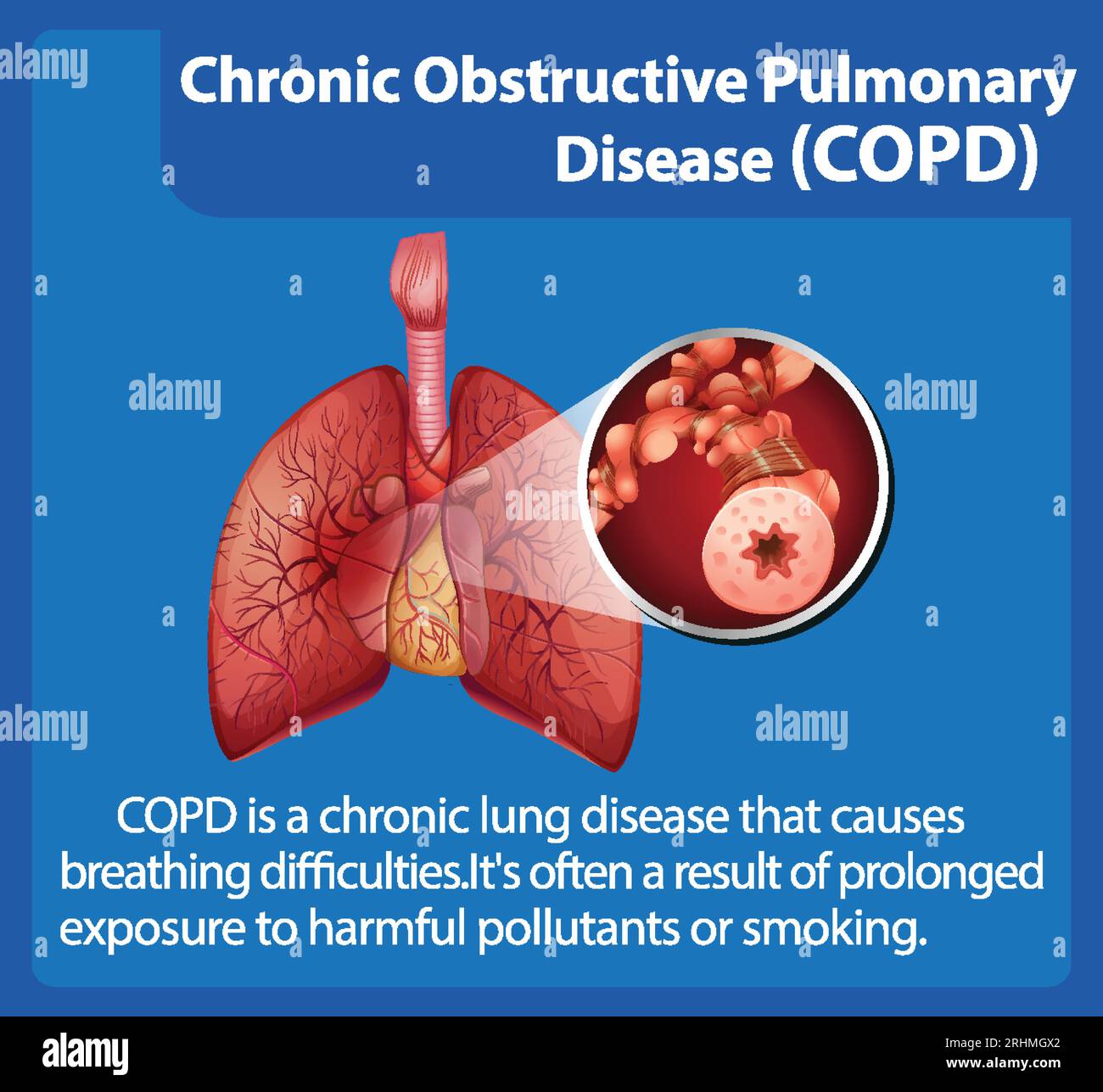 Illustrated infographic explaining chronic obstructive pulmonary ...
