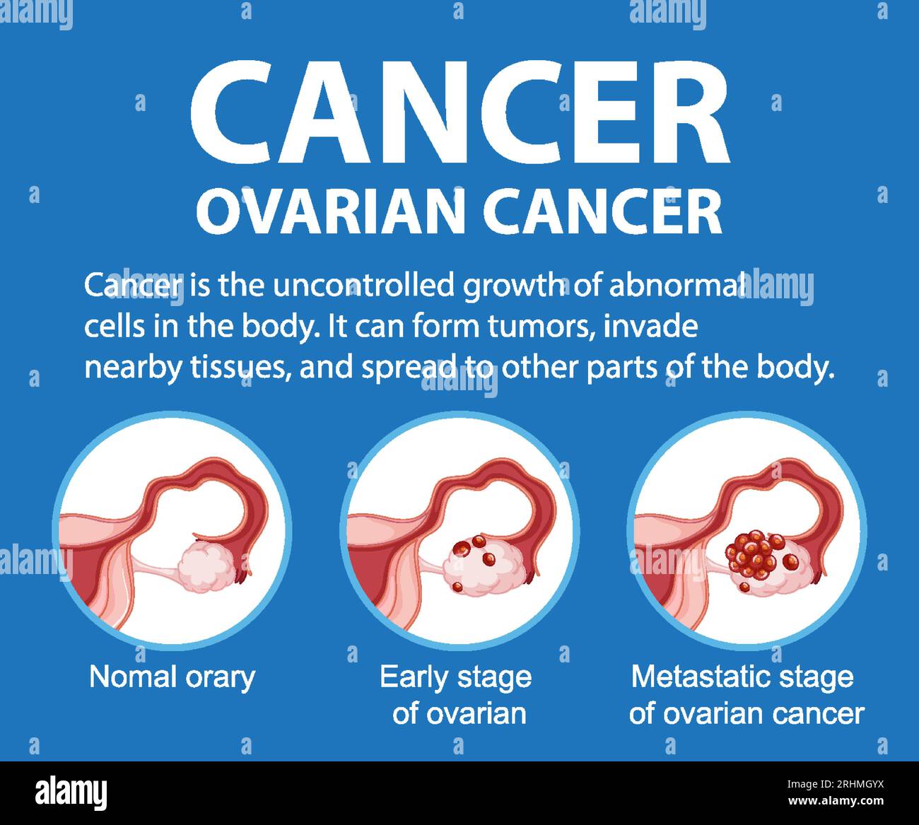 Illustrated infographic depicting stages of ovarian cancer in women ...