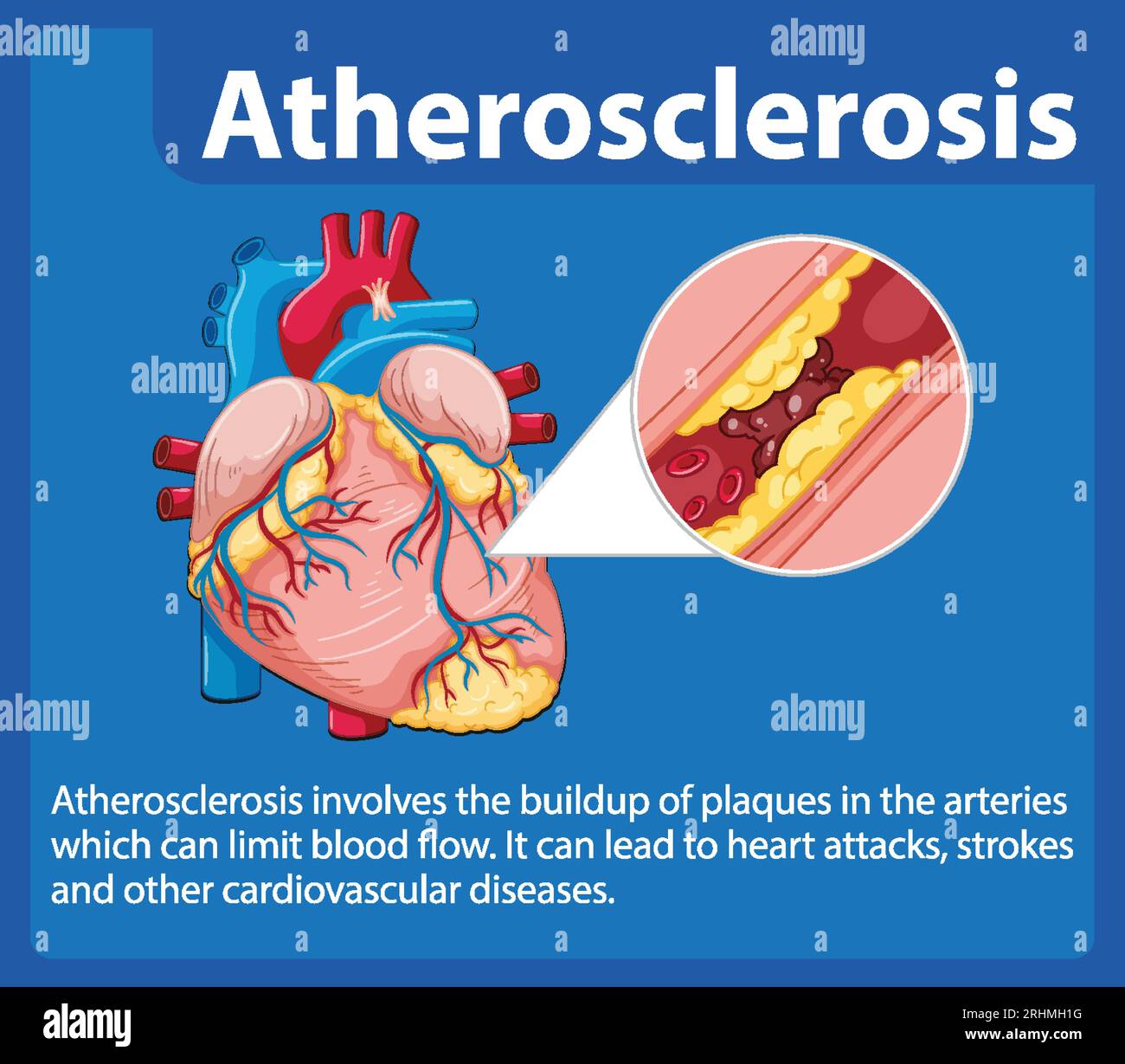 Learn about heart health and the development of atherosclerosis in this ...