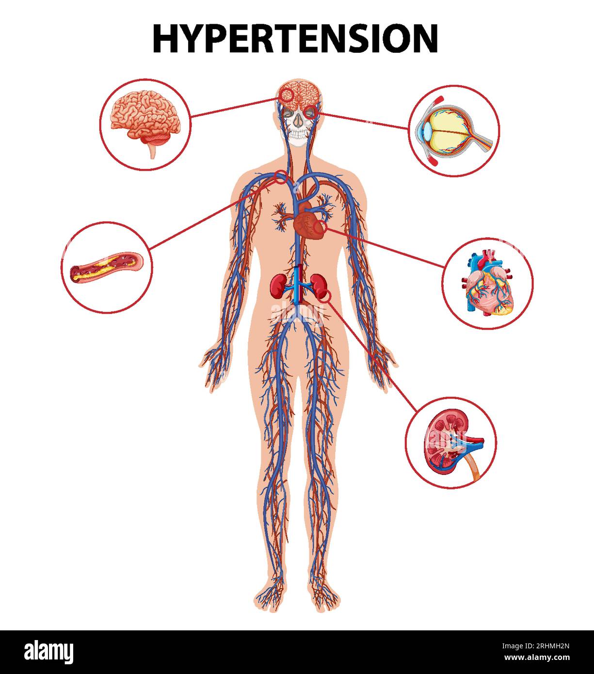 Illustrated guide to hypertension's impact on the human body Stock ...