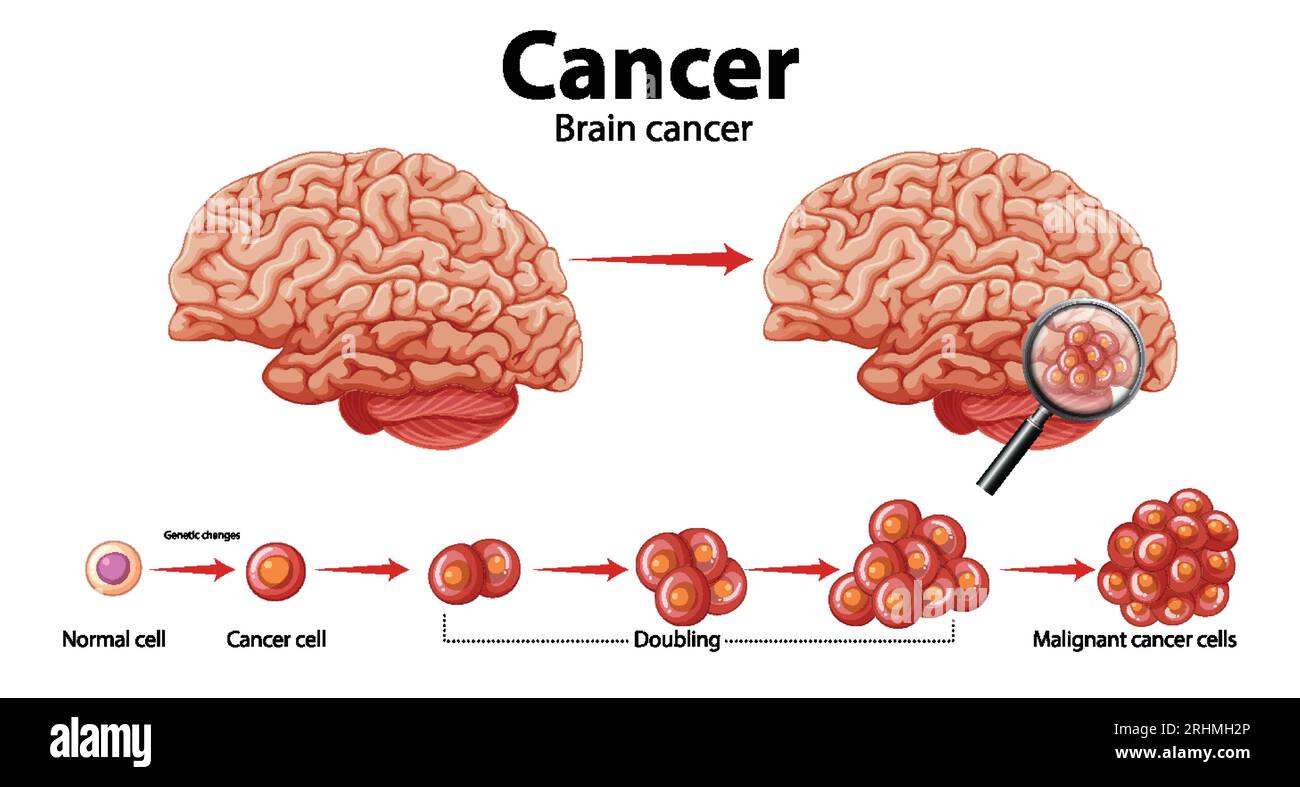 Illustrated guide to brain cancer and abnormal cell growth Stock Vector ...