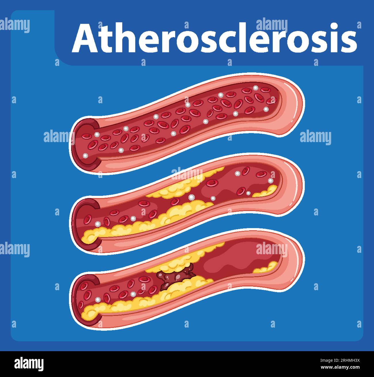 Illustrated infographic on heart health and cardiovascular disease ...