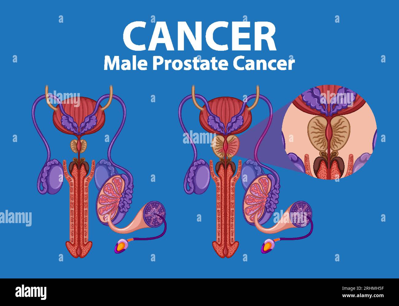 Illustrated infographic highlighting differences between healthy and cancerous prostate Stock ...
