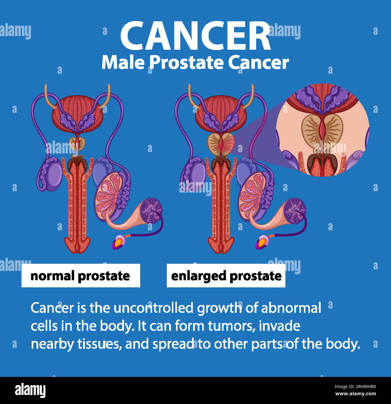Illustrated infographic highlighting differences between healthy and cancerous prostate Stock ...
