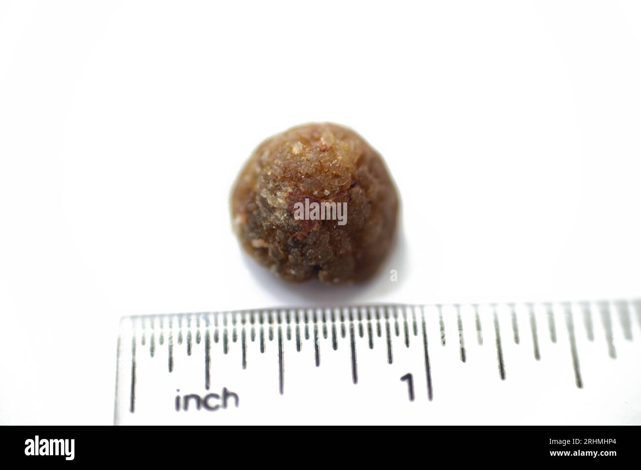 Large gallstone removed surgically after laparoscopic cholecystectomy ...