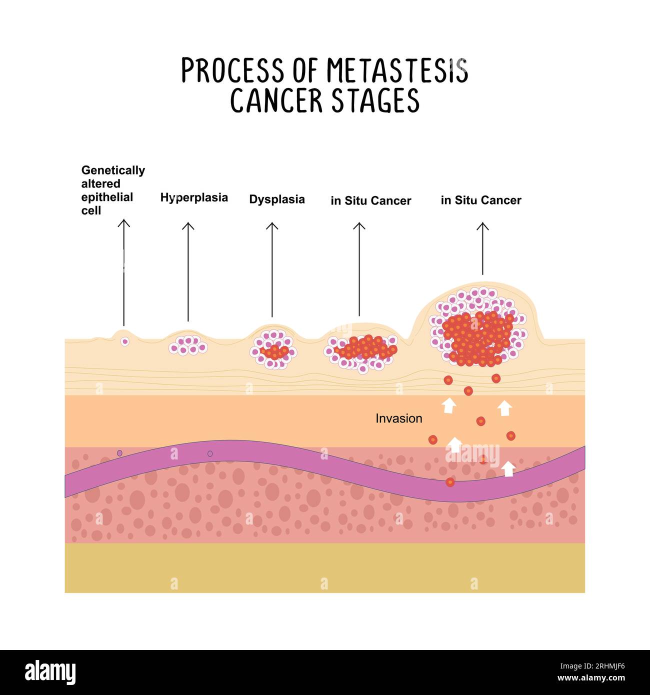 Stages Of Tumor Development And Mechanism Of Metastasis Download The invasion-metastasis cascade ...