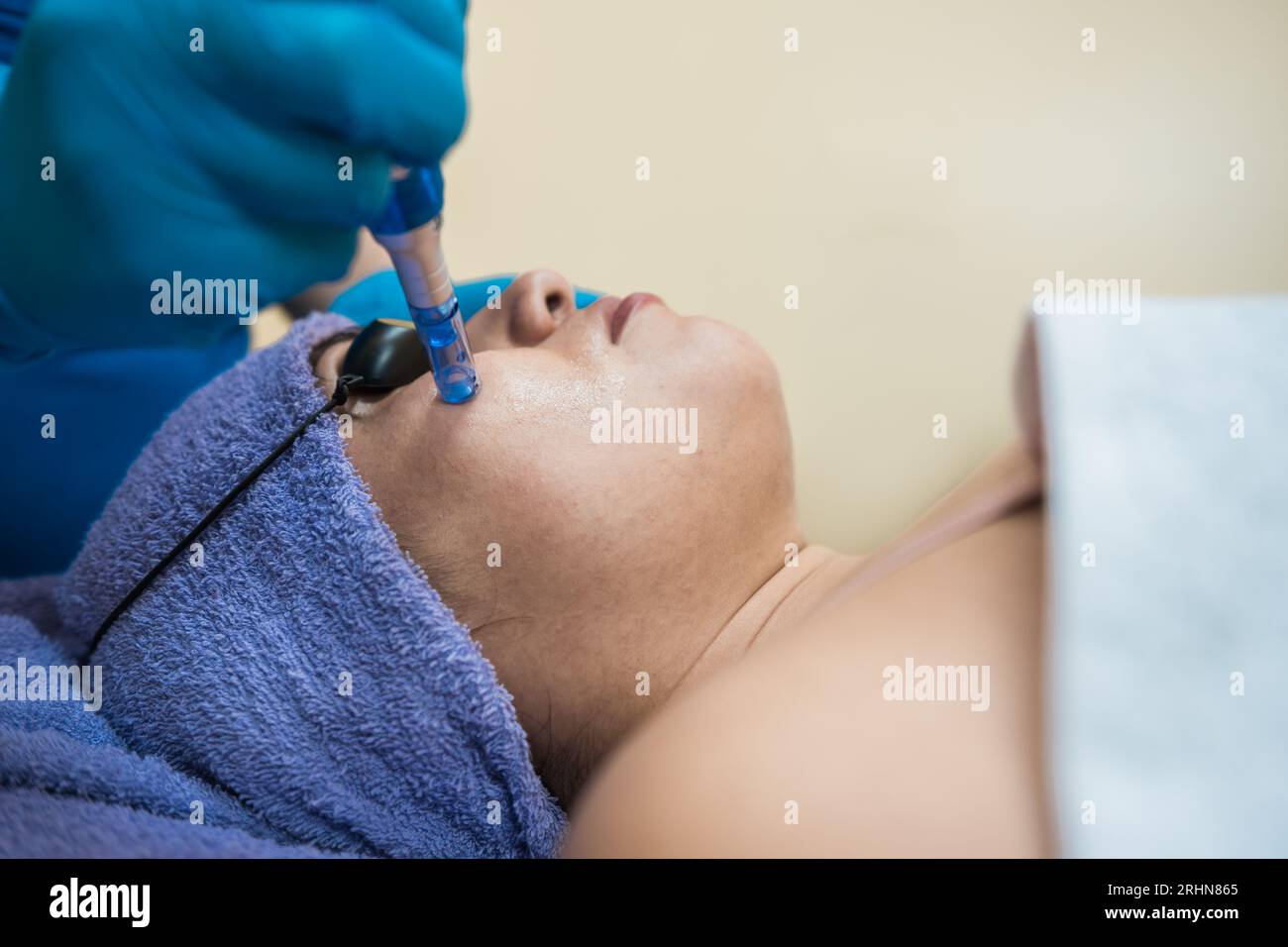 Facial treatment to a woman with dermapen and dermaplaning techniques ...