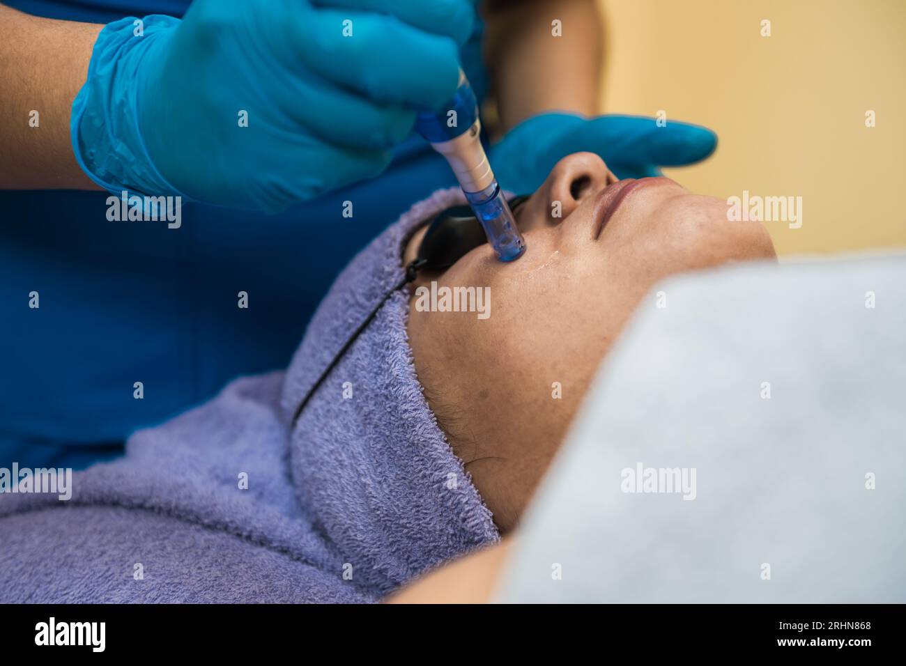 Facial treatment to a woman with dermapen and dermaplaning techniques ...