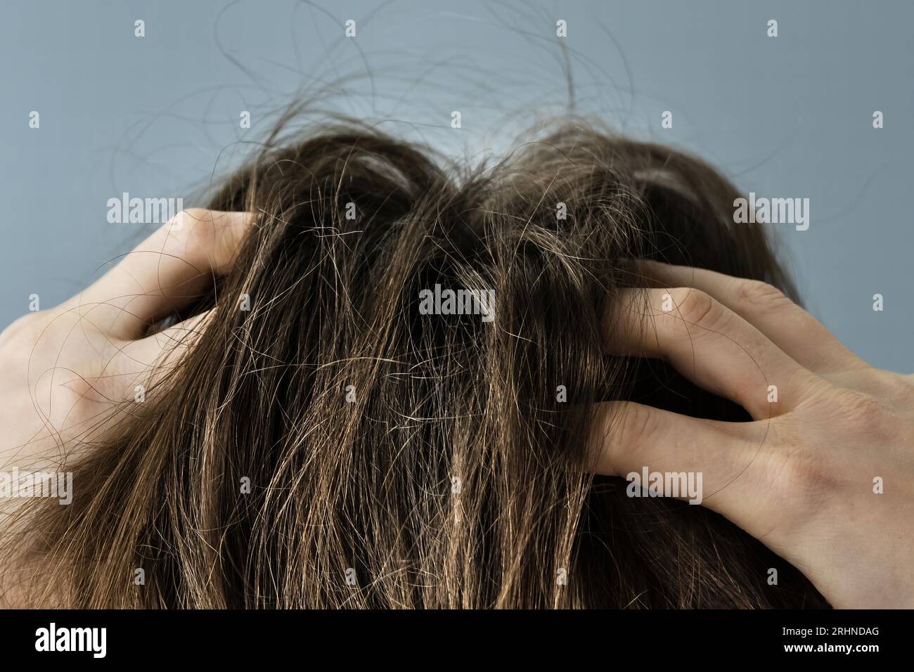 Itching Dry Head Scalp And Long Hair With Dandruff Stock Photo - Alamy