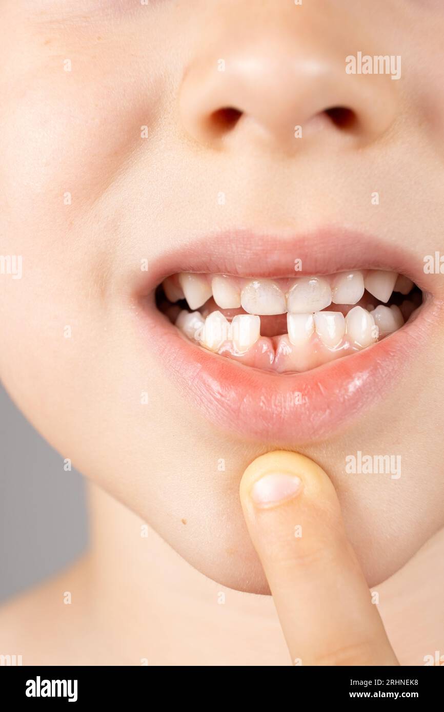 Loss of milk teeth in children. A six-year-old child shows the first ...