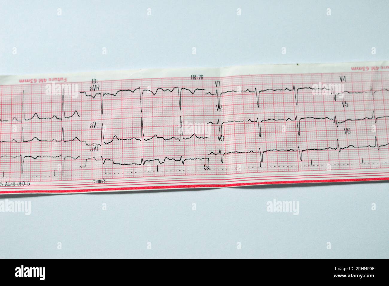 An ElectroCardioGraph ECG, a chart that draws the electricity of the ...