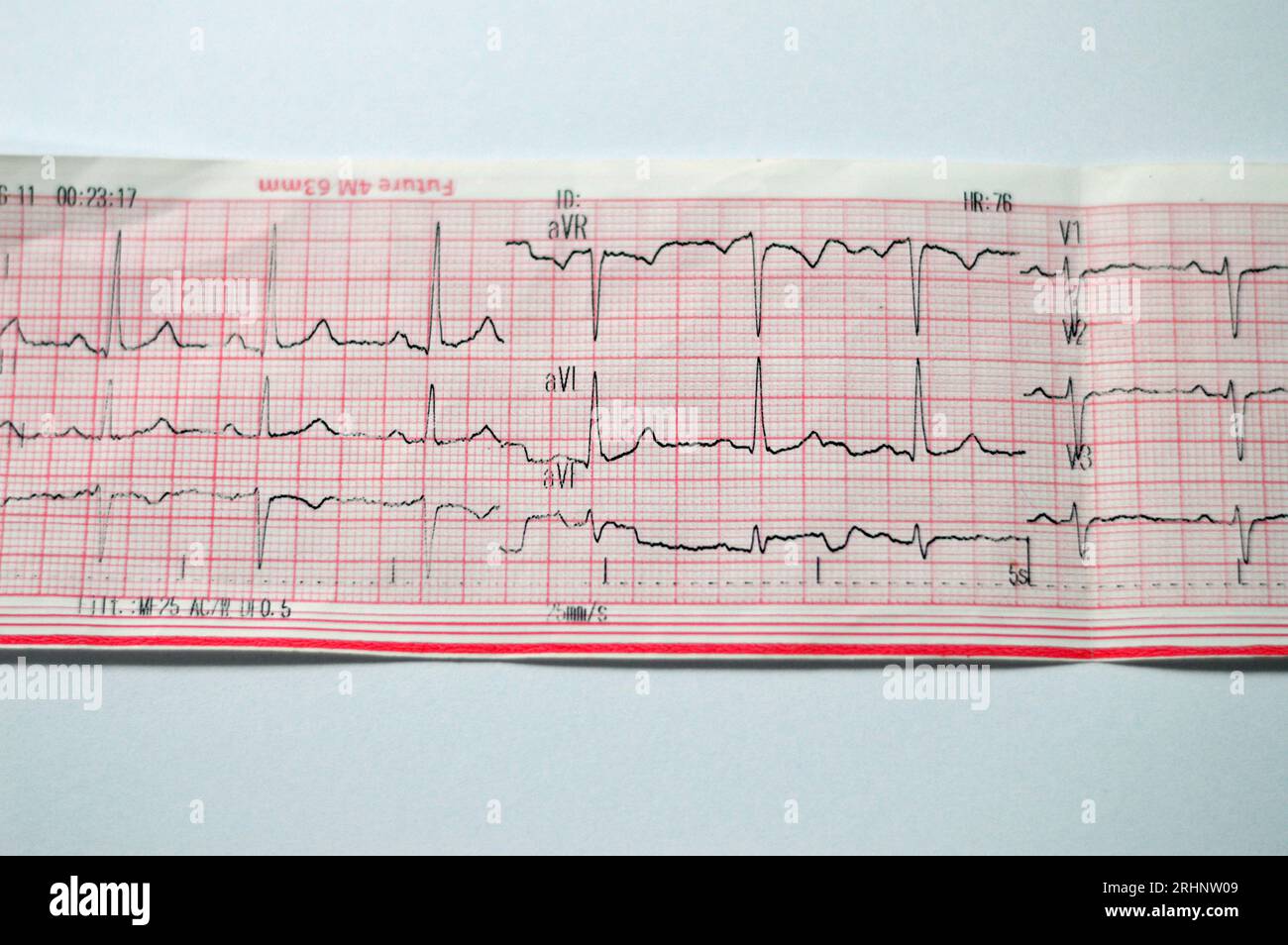 An ElectroCardioGraph ECG, a chart that draws the electricity of the ...