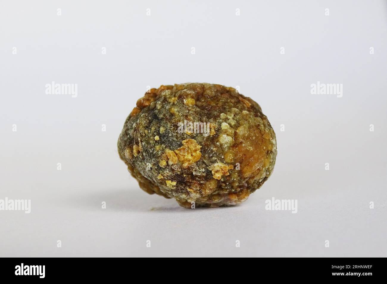 Gallstone, one week after removal Stock Photo - Alamy