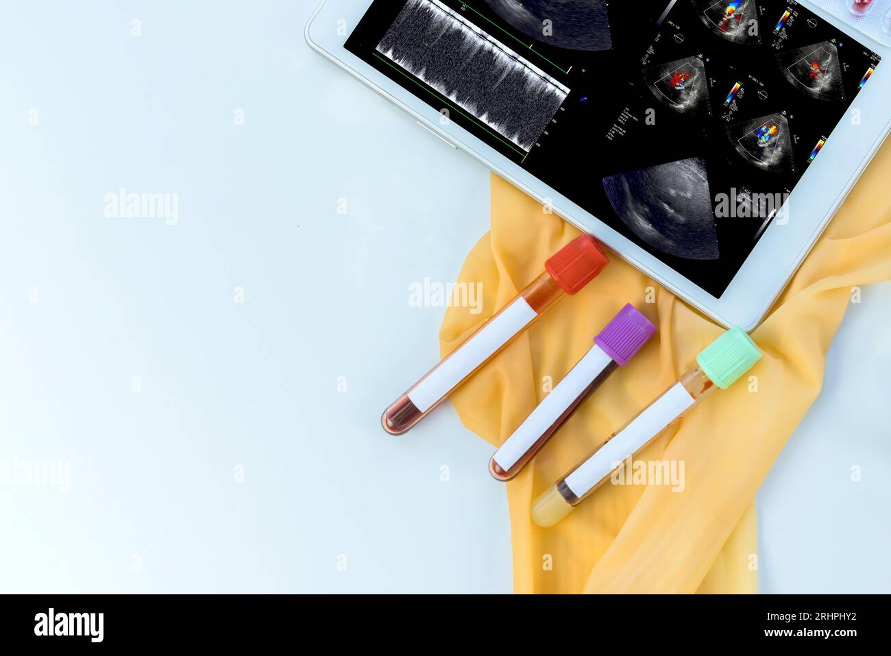 Patient cardiac activity is being monitored on an electrocardiogram ECG ...