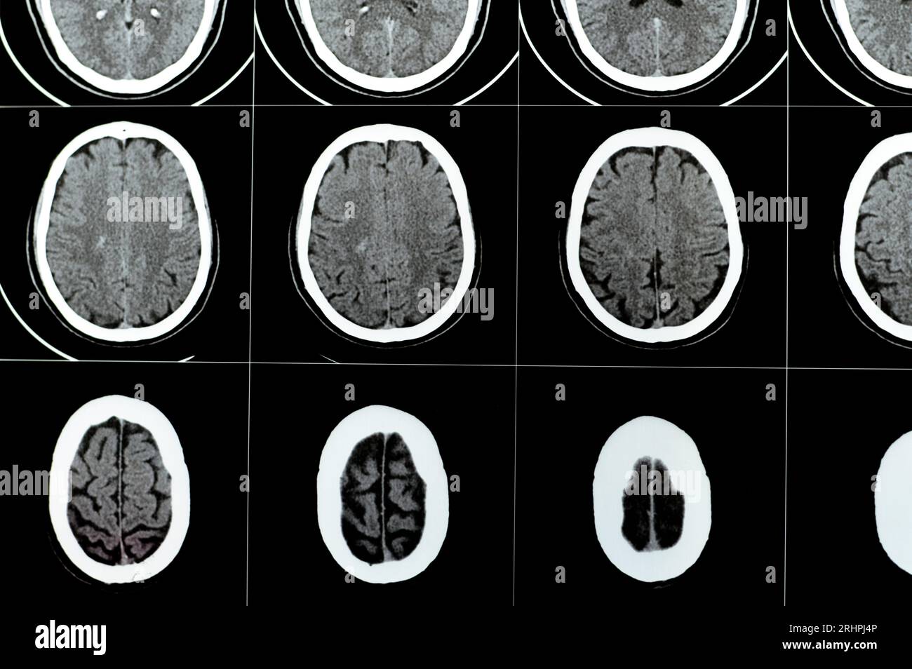 Multi slice CT scan of the brain showing Large brain stem and right ...