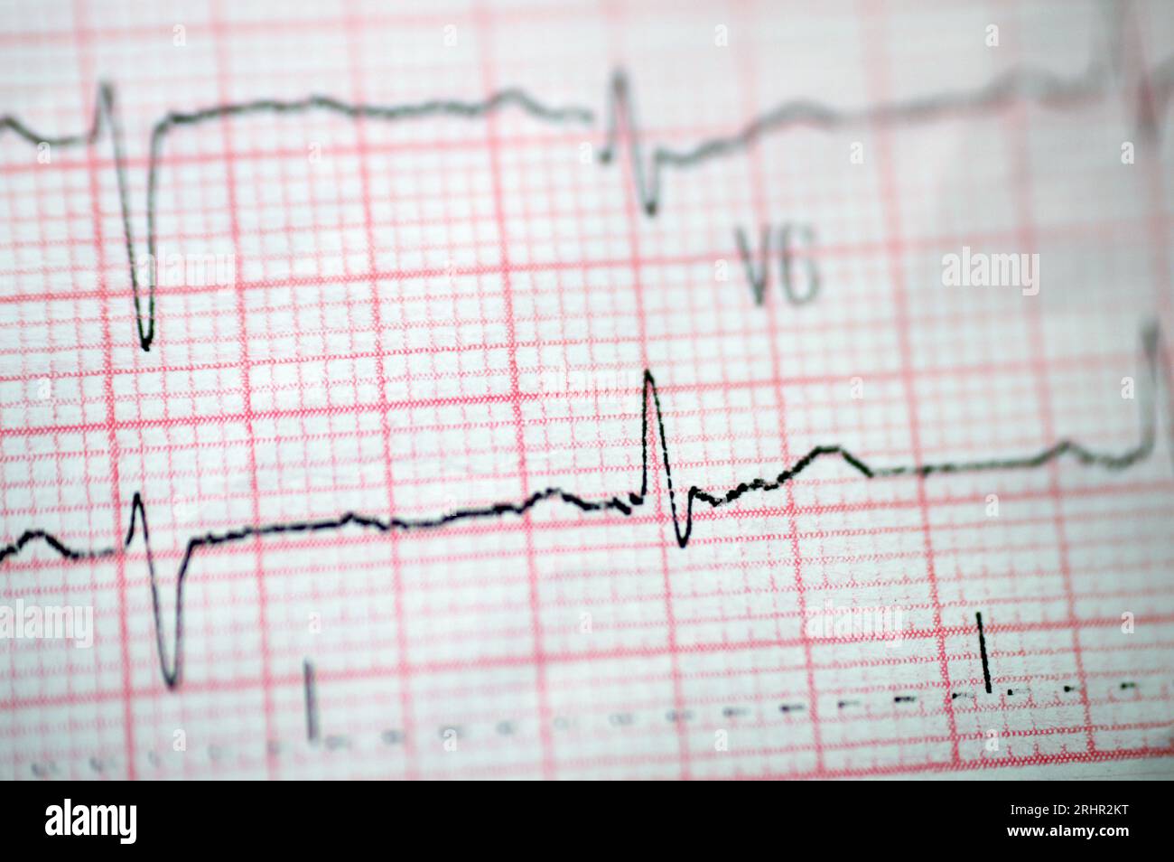 Heart attack ecg hi-res stock photography and images - Alamy