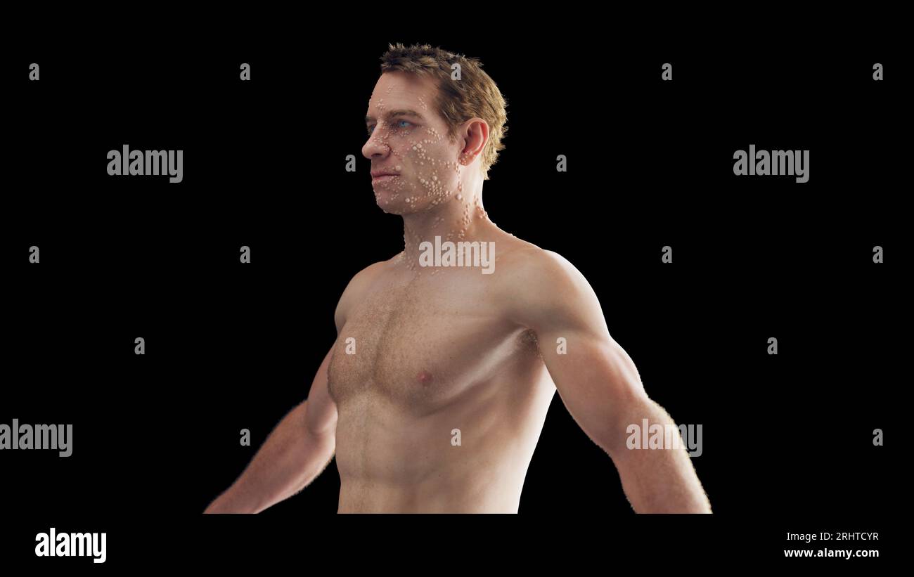 Human smallpox virus hi-res stock photography and images - Alamy