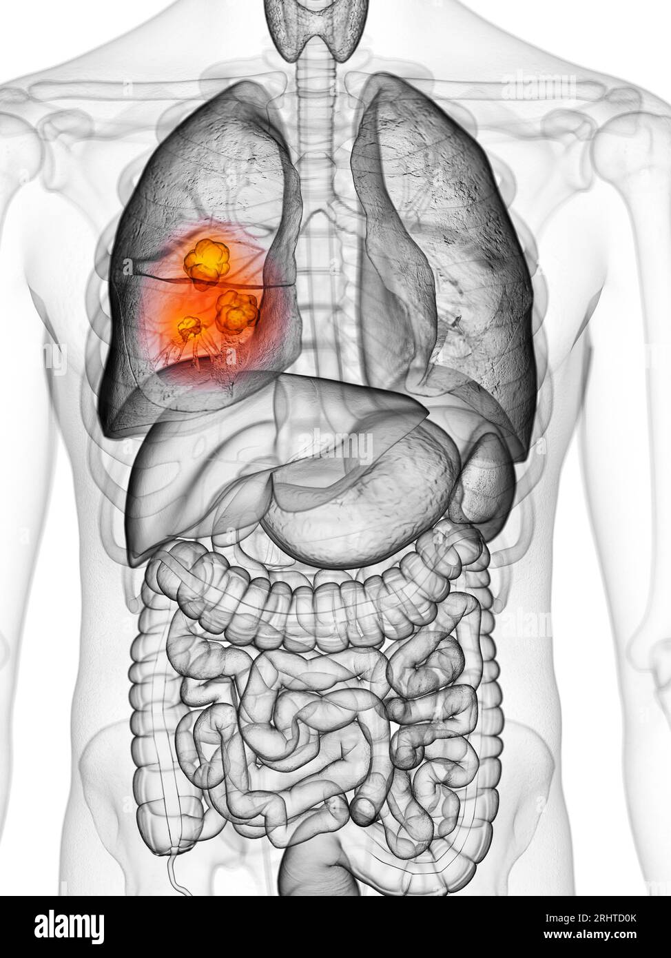 Lung cancer, illustration Stock Photo - Alamy