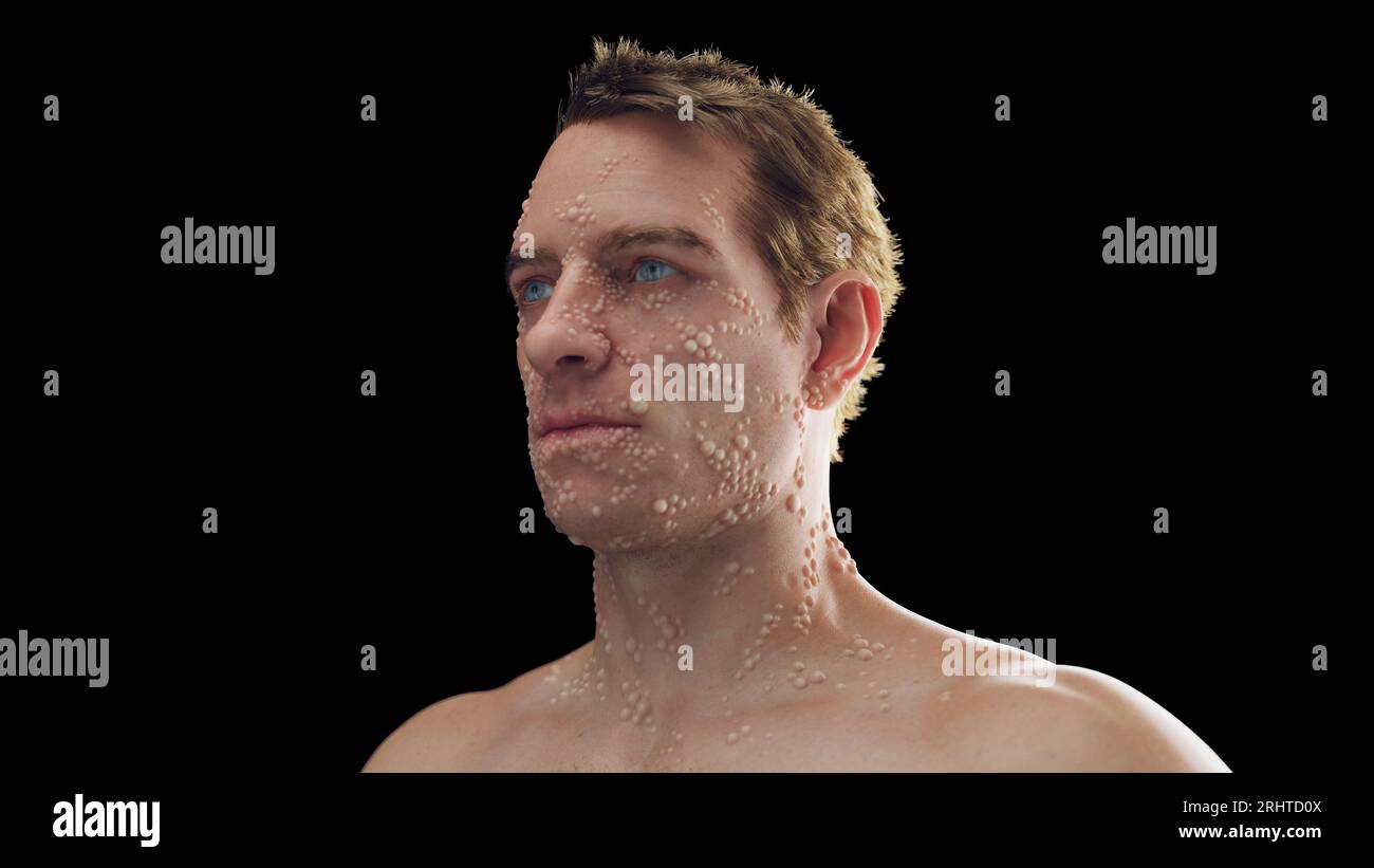 Smallpox infection, illustration Stock Photo - Alamy