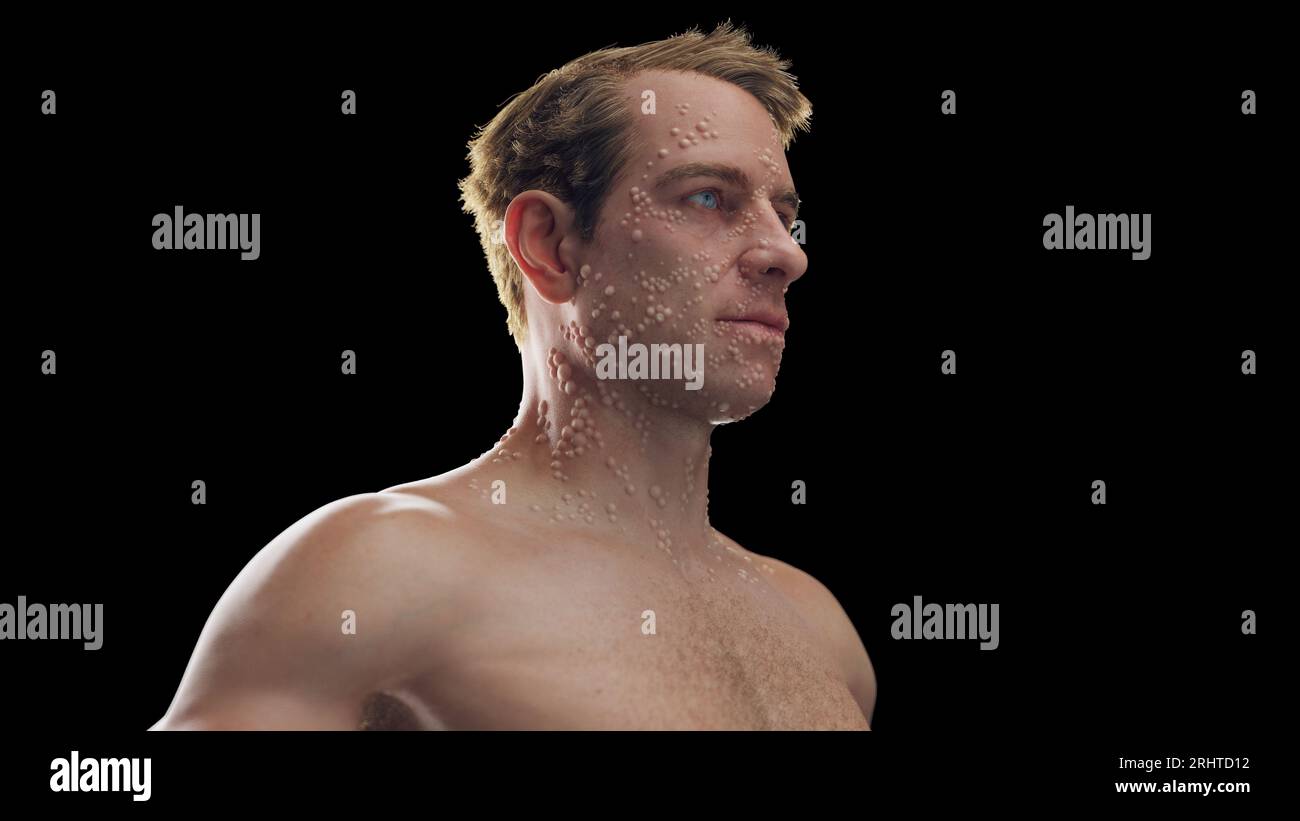 Man infected with smallpox hi-res stock photography and images - Alamy