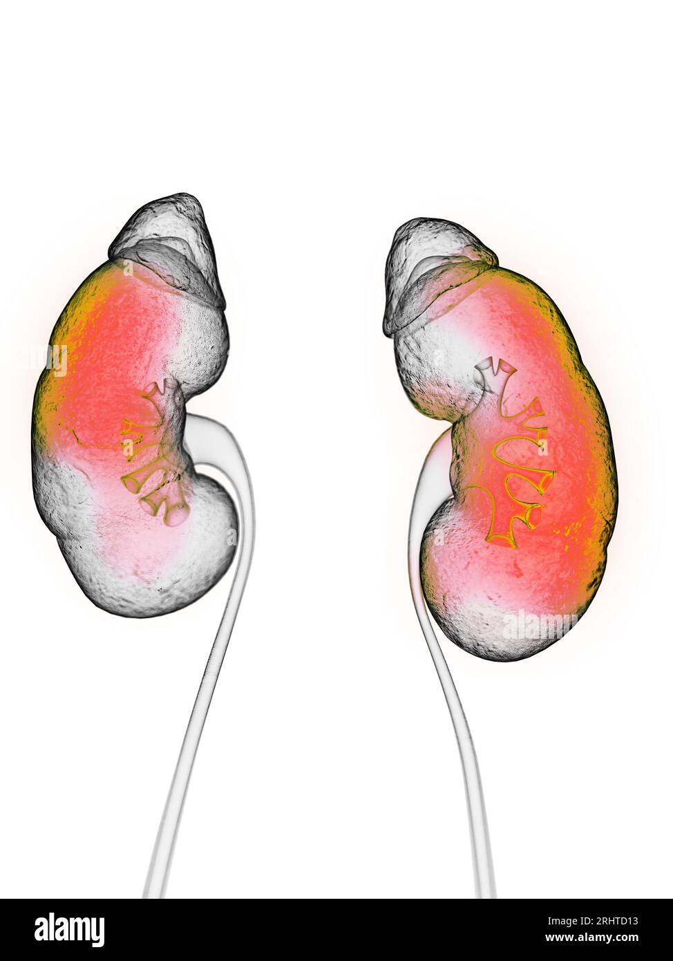 Inflamed kidneys, illustration Stock Photo - Alamy