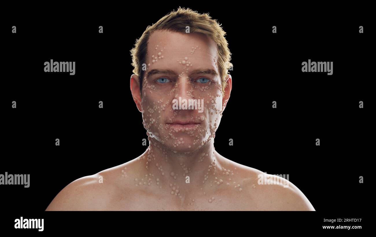Smallpox infection, illustration Stock Photo - Alamy