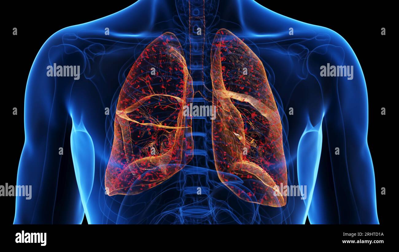 Lung infection, illustration Stock Photo - Alamy