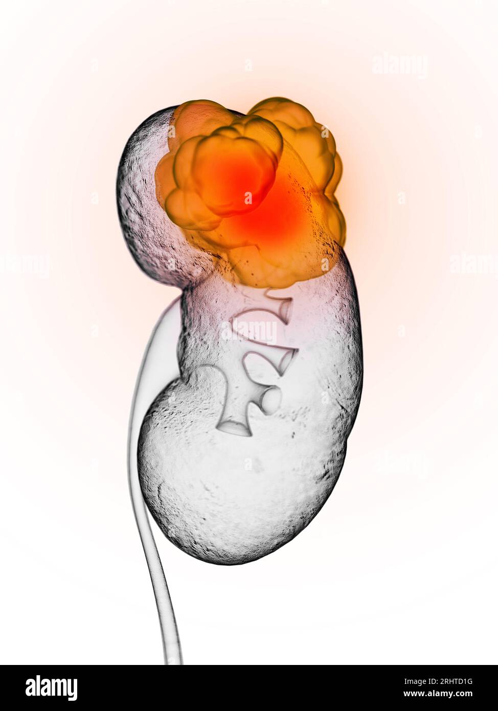 Kidney cancer, illustration Stock Photo - Alamy