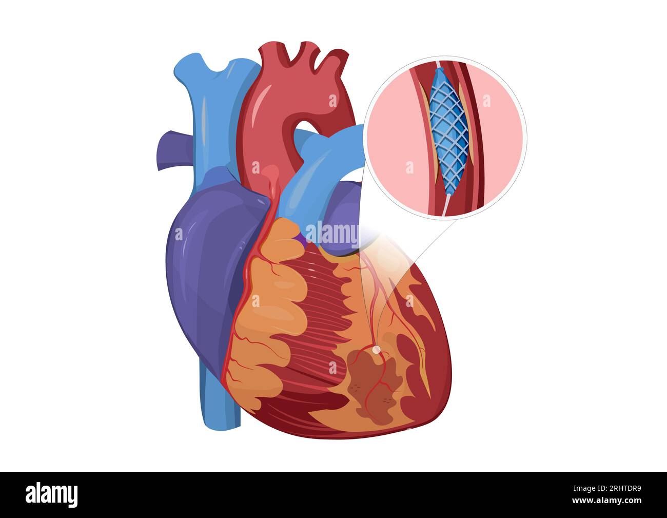 Human heart with stent, illustration Stock Photo - Alamy