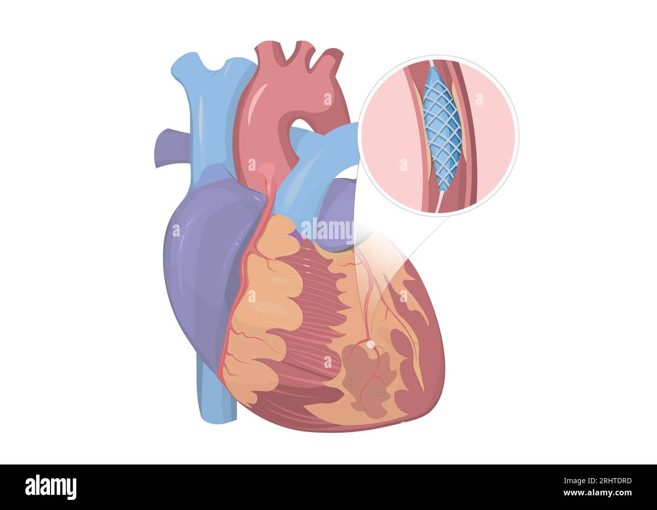 Human heart with stent, illustration Stock Photo - Alamy