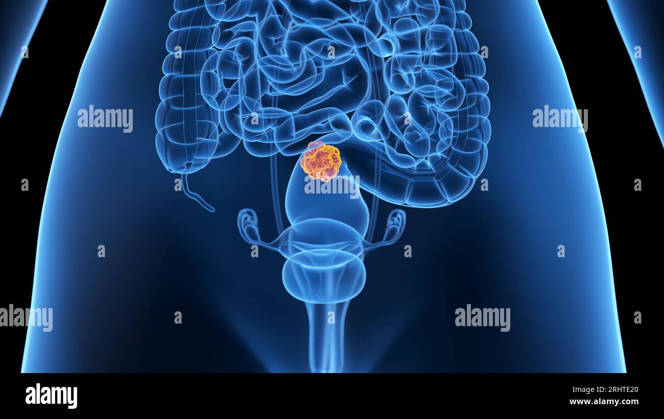 Colon and rectal cancer hi-res stock photography and images - Alamy