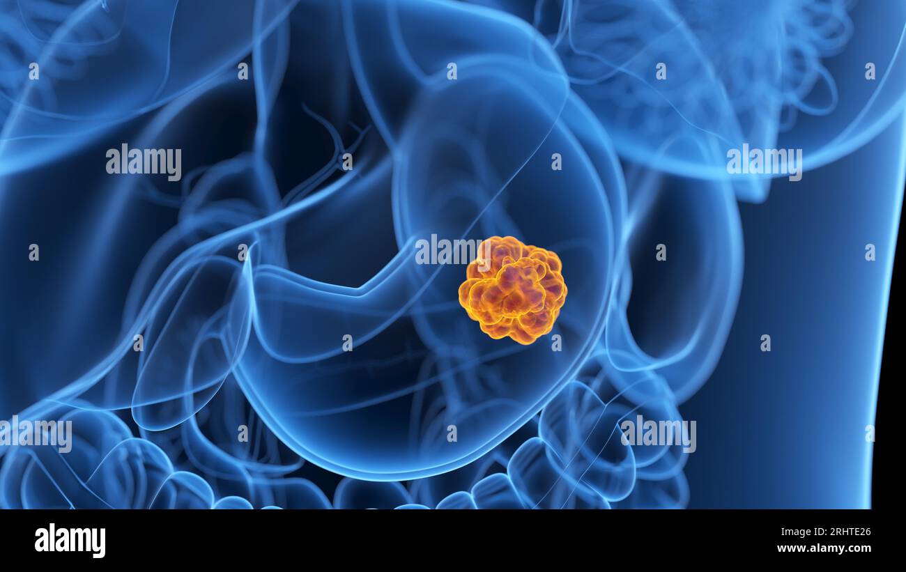 Stomach cancer, illustration Stock Photo - Alamy