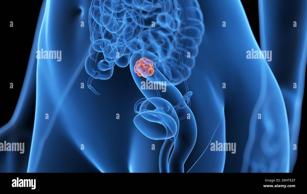 Colon cancer, illustration Stock Photo - Alamy