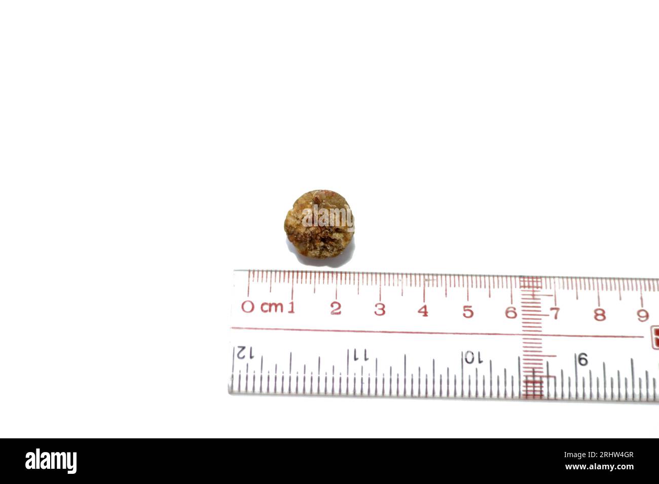 Large gallstone removed surgically after laparoscopic cholecystectomy ...