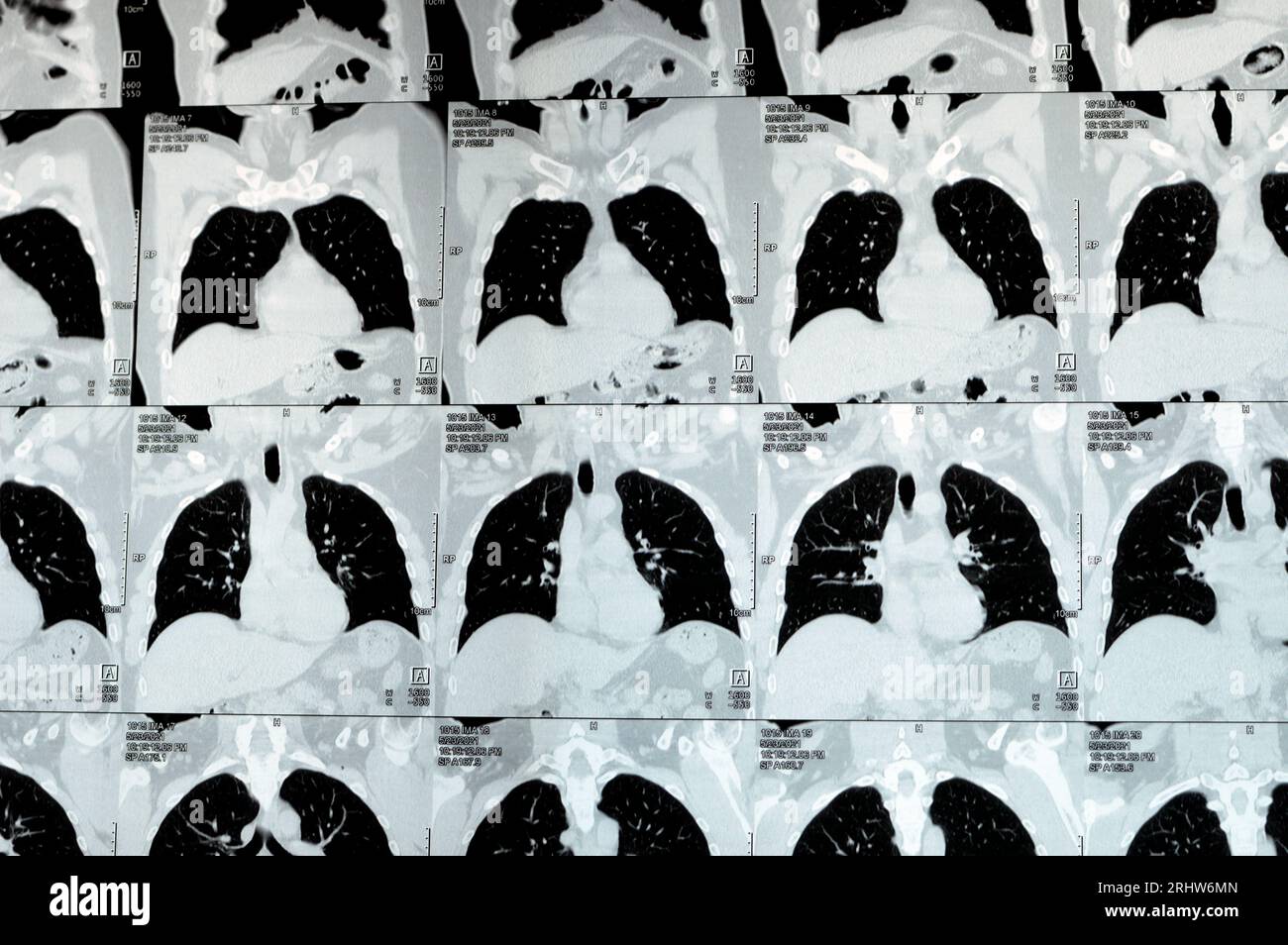 Multi slice CT scan of the chest showing normal study, normal ...