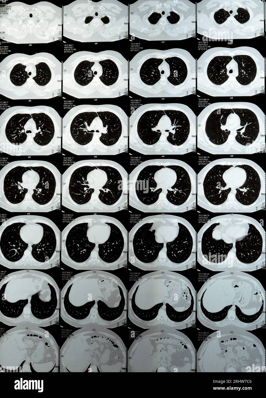 Multi slice CT scan of the chest showing normal study, normal ... Multi slice CT scan of the chest showing normal study, normal ...