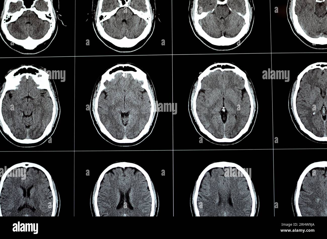 Brain CT scan showing brainstem cavernoma, right centrum semiovale ...